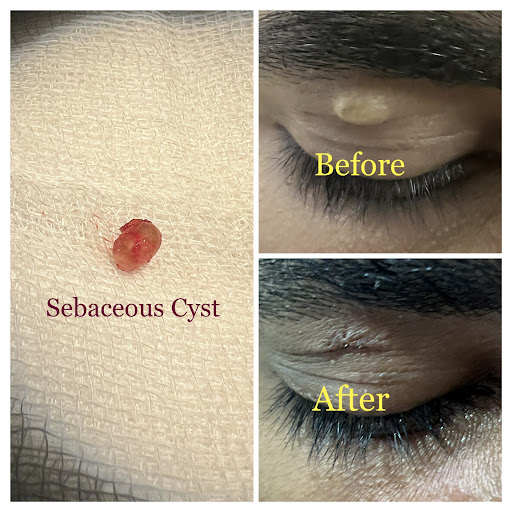 A sebaceous cyst is a non-cancerous – DR SAAD AZIZ